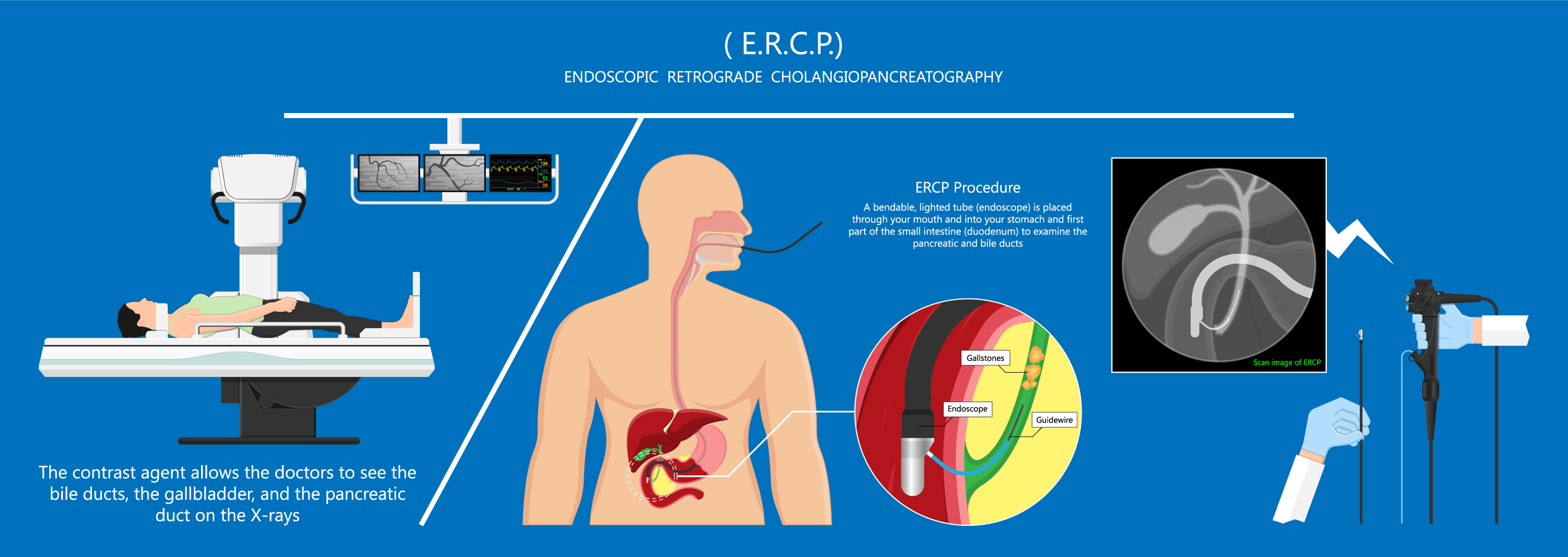 ERCP - Dubai Gastroenterology Clinic | Dubai Gastroenterology Clinic